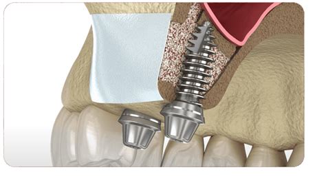Injerto De Hueso Dental Red Implantologia Viña