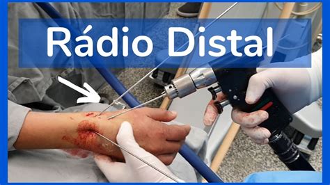 Fratura Rádio Distal Fio De Kirschner Retoedu