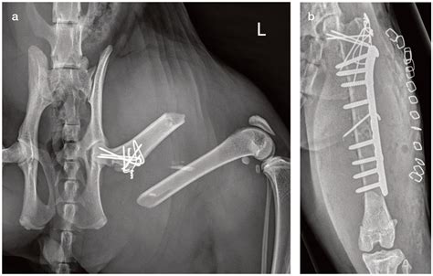 Impacted Fracture Femur
