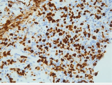 Ki 67 Staining Of Lymph Node 400x Power Download Scientific Diagram