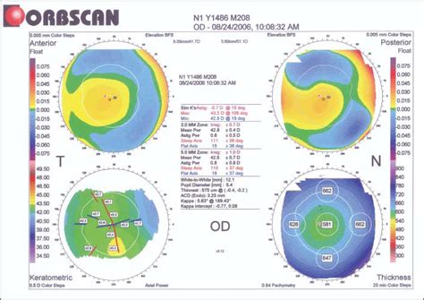 Role Of Orbscan Ii In Screening Keratoconus Suspects Before Refractive Corneal Surgery Tal