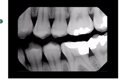 Detection Of Radiographic Decay Flashcards Quizlet