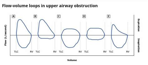 Review In Pulmonary Function Test Flowvolumeloops A Normal Flow