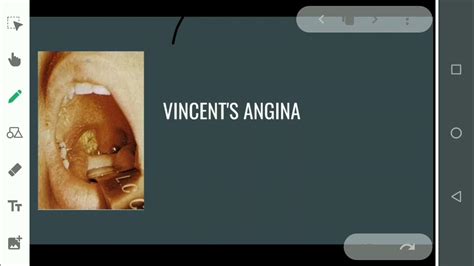 Acute Necrotizing Ulcerative Gingivitisvincents Anginasimple And