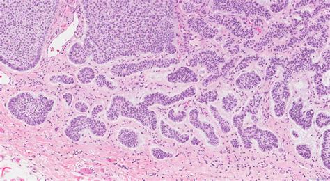 Basal Cell Carcinoma Of The Skin Ottawa Atlas Of Pathology