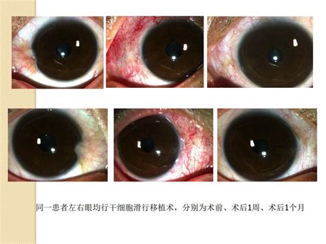 翼状胬肉手术美容原则和方法 中国眼科网