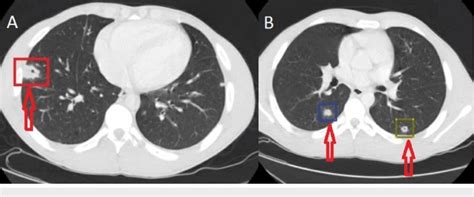 Ct Of The Chest With Iv Contrast Showing Several Scattered Lung Nodules