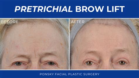 5 Types Of Brow Lifts Discover The Procedures And Benefits