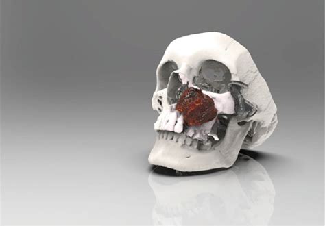 6 3d Planning For Resection Of Maxillary Lesion And Position Of Cutting Download Scientific