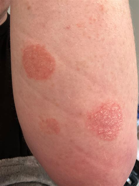 Psoriasis Or Excema Rskin