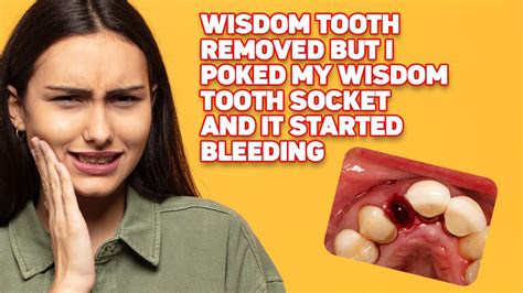 Tooth Socket Keeps Bleeding At Heidi Burkholder Blog