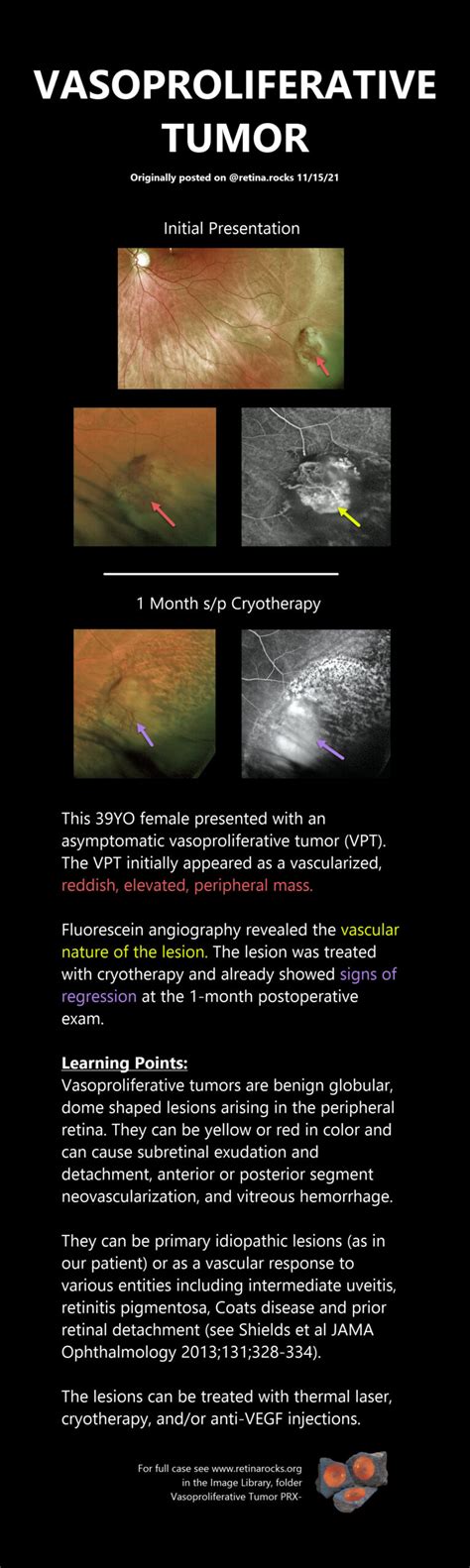 Neoplastic Retina Disorders Vasoproliferative Tumor Retina Rocks