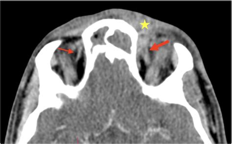 Ct Scan Preseptal And Post Septal Cellulitis Star Associated To A Download Scientific Diagram