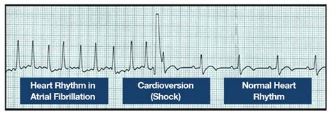 Cardioversion Side Effects