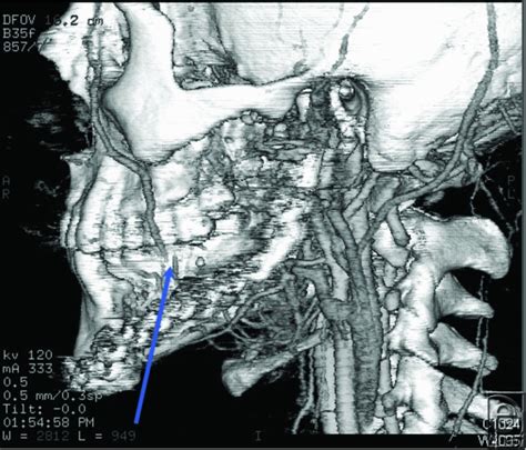 Cta Of Recipient Site For Head And Neck Reconstruction Cta Of Head And