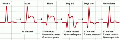 Gambaran Abnormal Dan Perubahan Morfologi Pada Gelombang Ekg Portal
