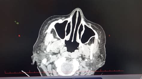 Video Sima Sheikhghomi On Linkedin Right Eye Trochleitis A 60 Year