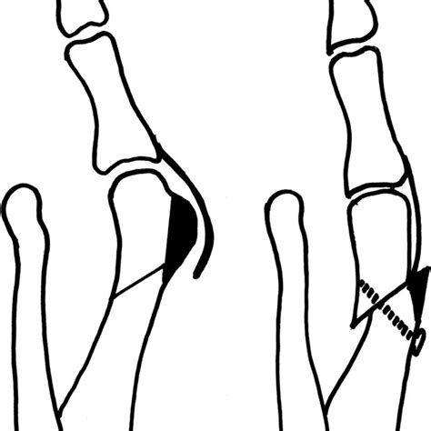 Mitchell Metatarsal Osteotomy Scheme Capsular Incision Followed By Download Scientific Diagram