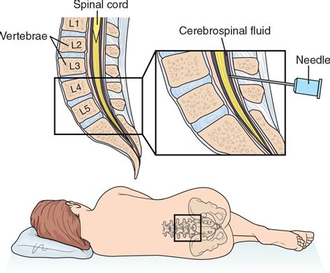 Lumbar Puncture Opening Pressure Whats In A Tap Csf Analysis — Taming