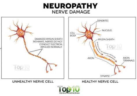 Nerve Damage Causes Symptoms And Complications Top 10 Home Remedies