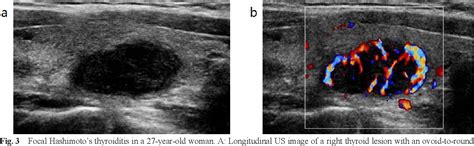 Figure 3 From Ultrasonographic Appearance Of Focal Hashimotos