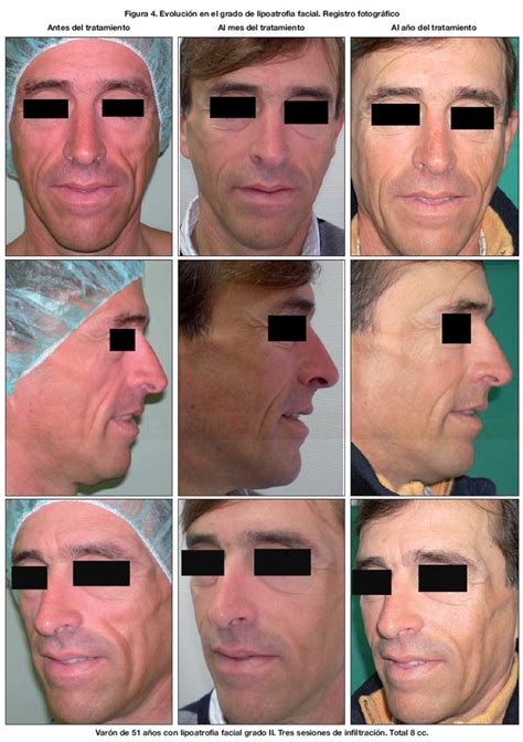Evaluación Del Tratamiento De La Lipoatrofia Facial Con Gel De