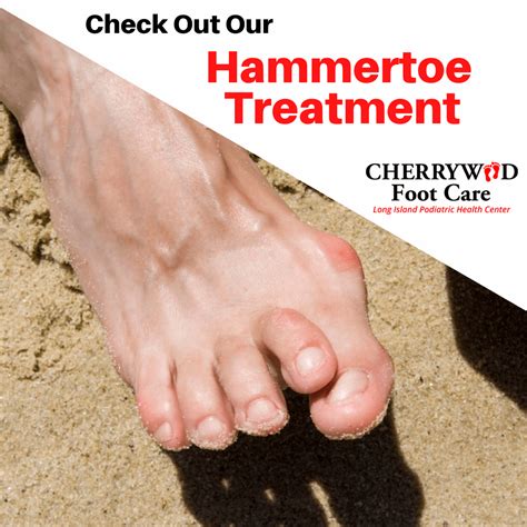 Ways To Prevent Hammer Toe Cherrywood Foot Care
