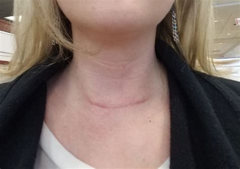 Life After Thyroidectomy Parathyroidectomy Photos Artofit