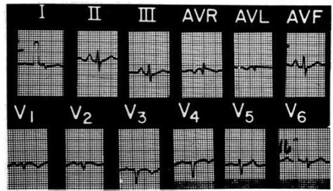 Pseudo Left Axis Deviation And The S1s2s3 Syndrome In Chronic Airway