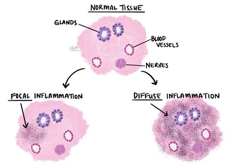 විසරණය Mypathologyreport