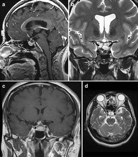 Imaging Findings Of Xanthomatous Hypophysitis Associated With Rathkes