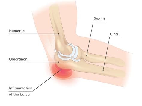 Olecranon Bursitis What Does Elbow Bursitis Look And Feel Like