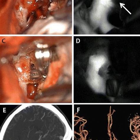 Intra Operative Findings A In Situ Blister Like Aneurysm Note The