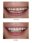 How To Fix Different Sized Teeth Treat Uneven Teeth