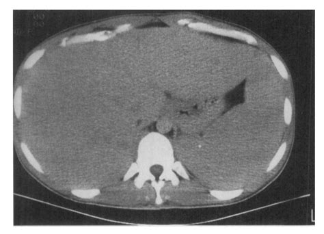 Computed Tomographic Scan After Treatment Download Scientific Diagram