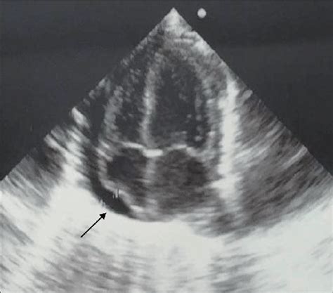 Echocardiogram Showing The Pericardial Effusion Pce With Systolic