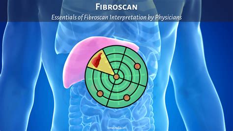 Essentials Of Fibroscan Interpretation By Physicians Cme India