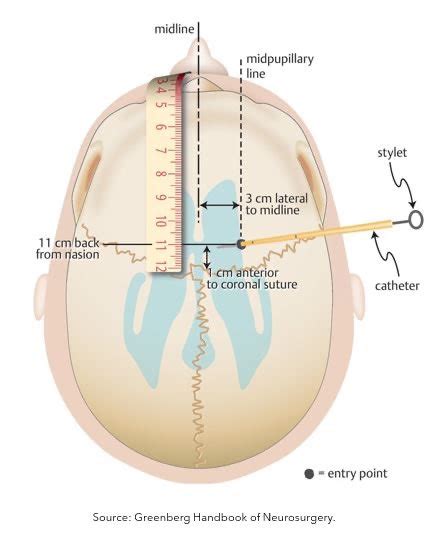 External Ventricular Drains Evds Are One Of The Most Common
