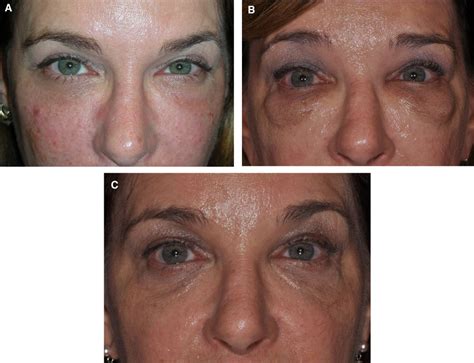 Tyndall Effect Juvederm