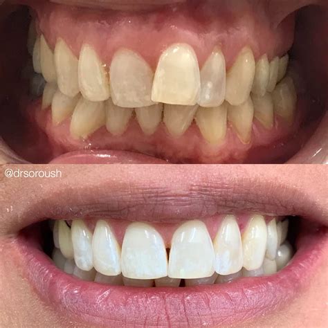 Invisalign® Clear Aligners Maple Ridge Maple Ridge Orthodontics