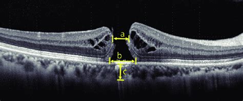Macular Hole Parameters Measured In Optical Coherence Tomography Scans