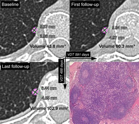 Solid Pulmonary Nodule With Smooth Margins Located In The Right Lower