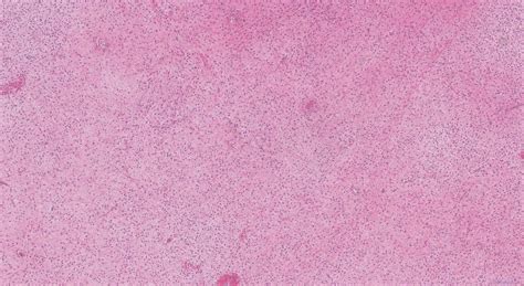 Thecoma Of The Ovary Ottawa Atlas Of Pathology