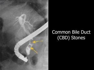 Approach To Common Bile Duct Stones Pdf