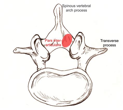 Sports Injury Bulletin Diagnose And Treat Lumbar Spondylolysis In