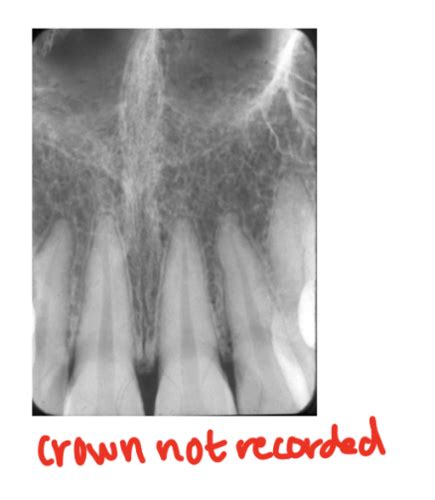 Week 2 Identification Of Intraoral Radiography Errors And Corrections Flashcards Quizlet
