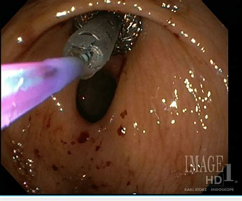 Deployment Of A Transgastric Biliary Drain Through The Gastric Wall