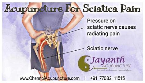 Acupuncture Treatment For Sciatica In Chennai At ₹ 600session In