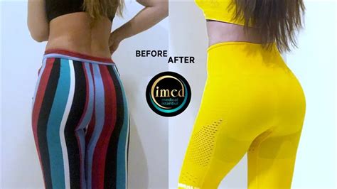 Brazilian Butt Lift Safe Bbl Imed Medical