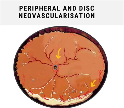 Intermediate Uveitis Understanding Symptoms Signs And Complications